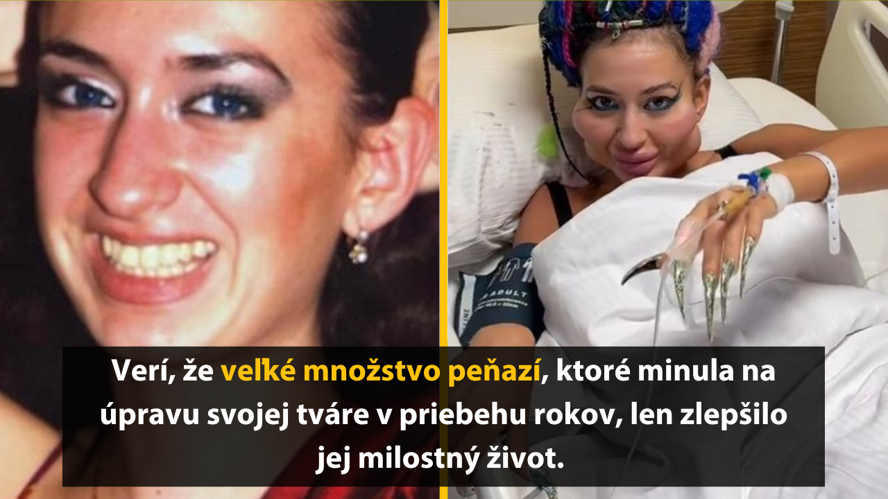 Pozrite sa, ako kedysi vyzerala žena, ktorá má teraz najväčšie líca na svete